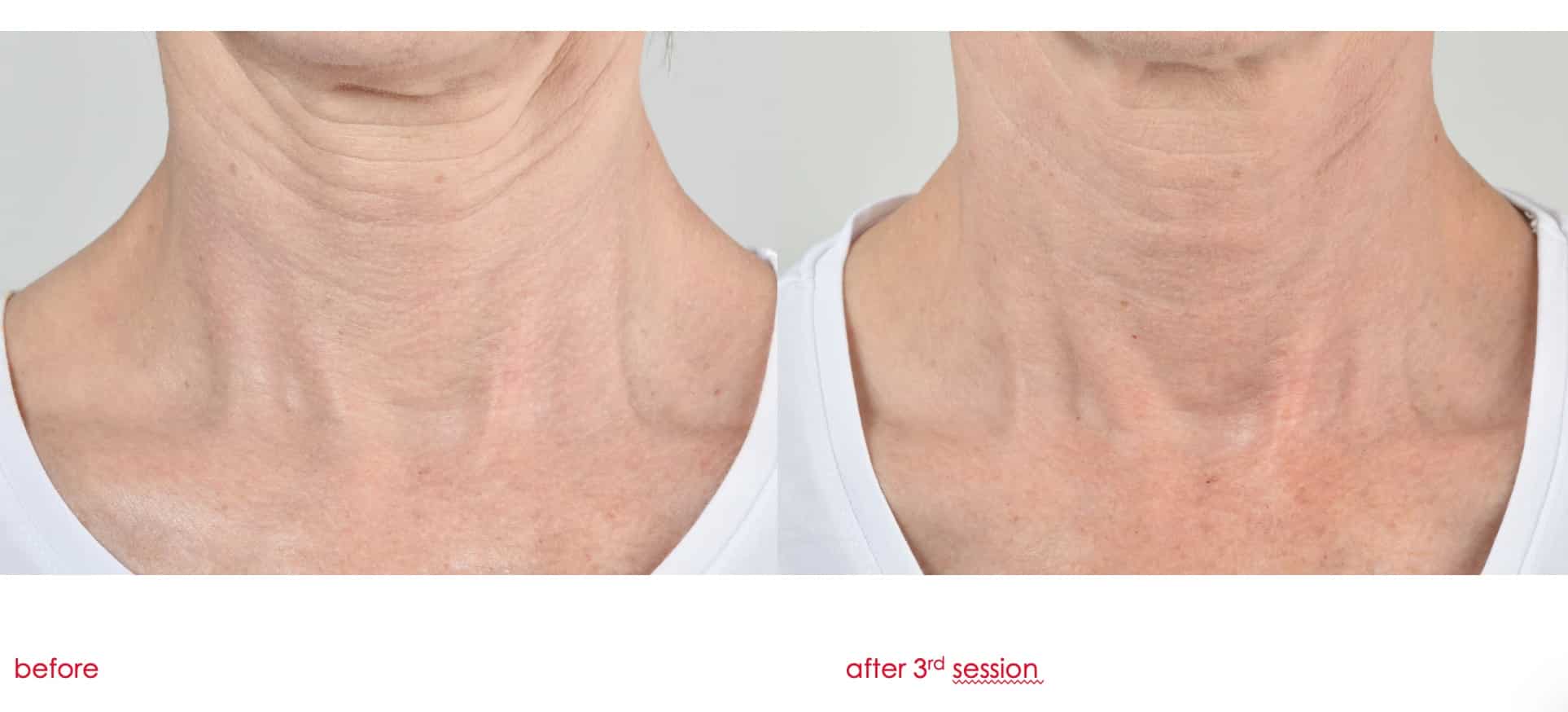 Polynucleotides skin rejuvenation - FTT Skin Clinics