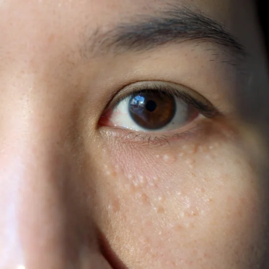 Milia Treatments - FTT Skin Clinics