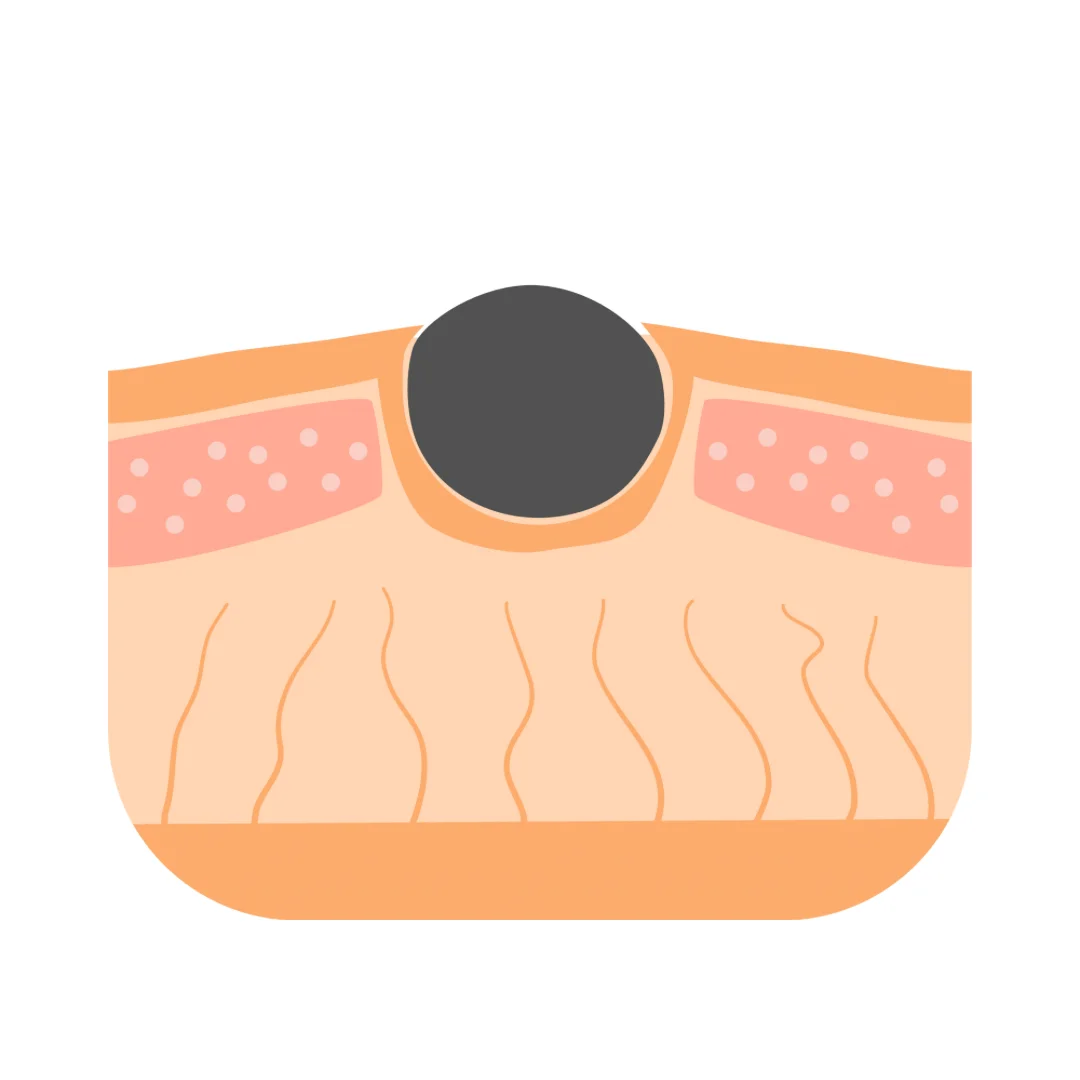 Blackheads Treatments - FTT Skin Clinics